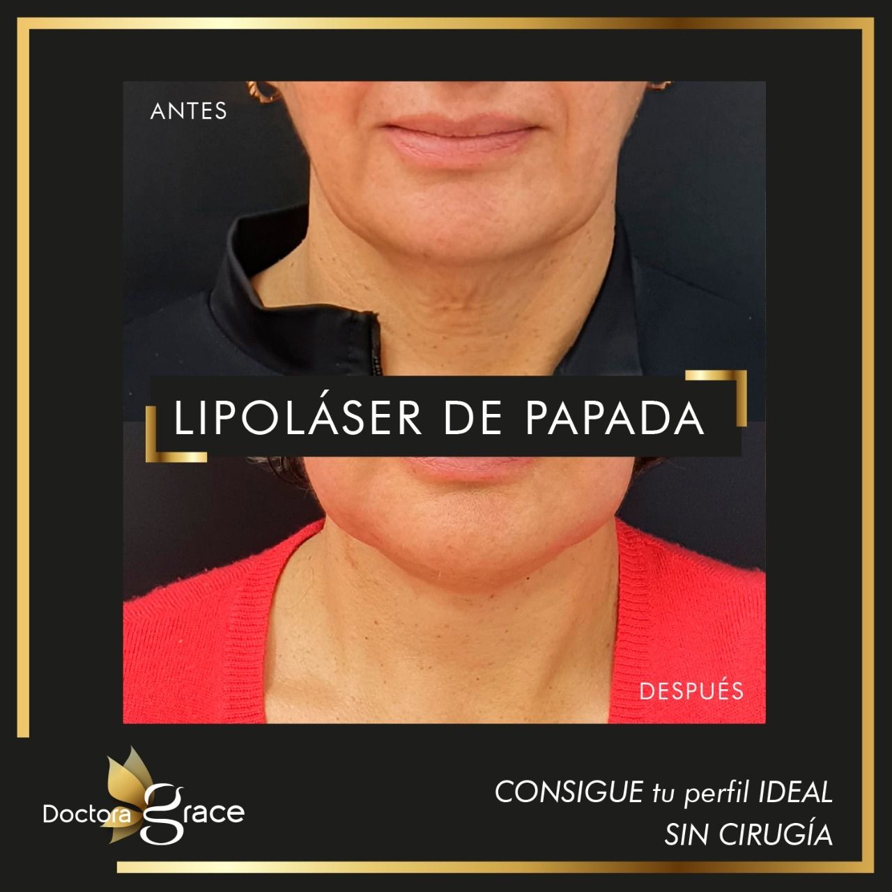 Lipólisis Antes y después - Multiestetica.mx - Multiestetica.mx