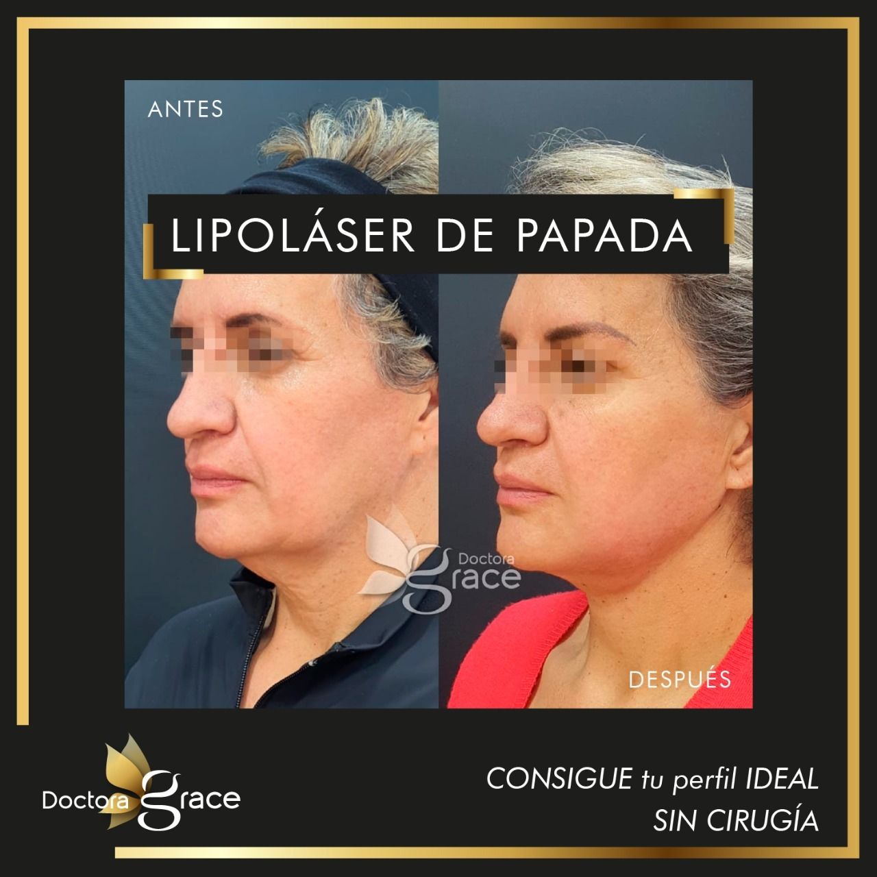 Lipólisis Antes y después - Multiestetica.mx - Multiestetica.mx