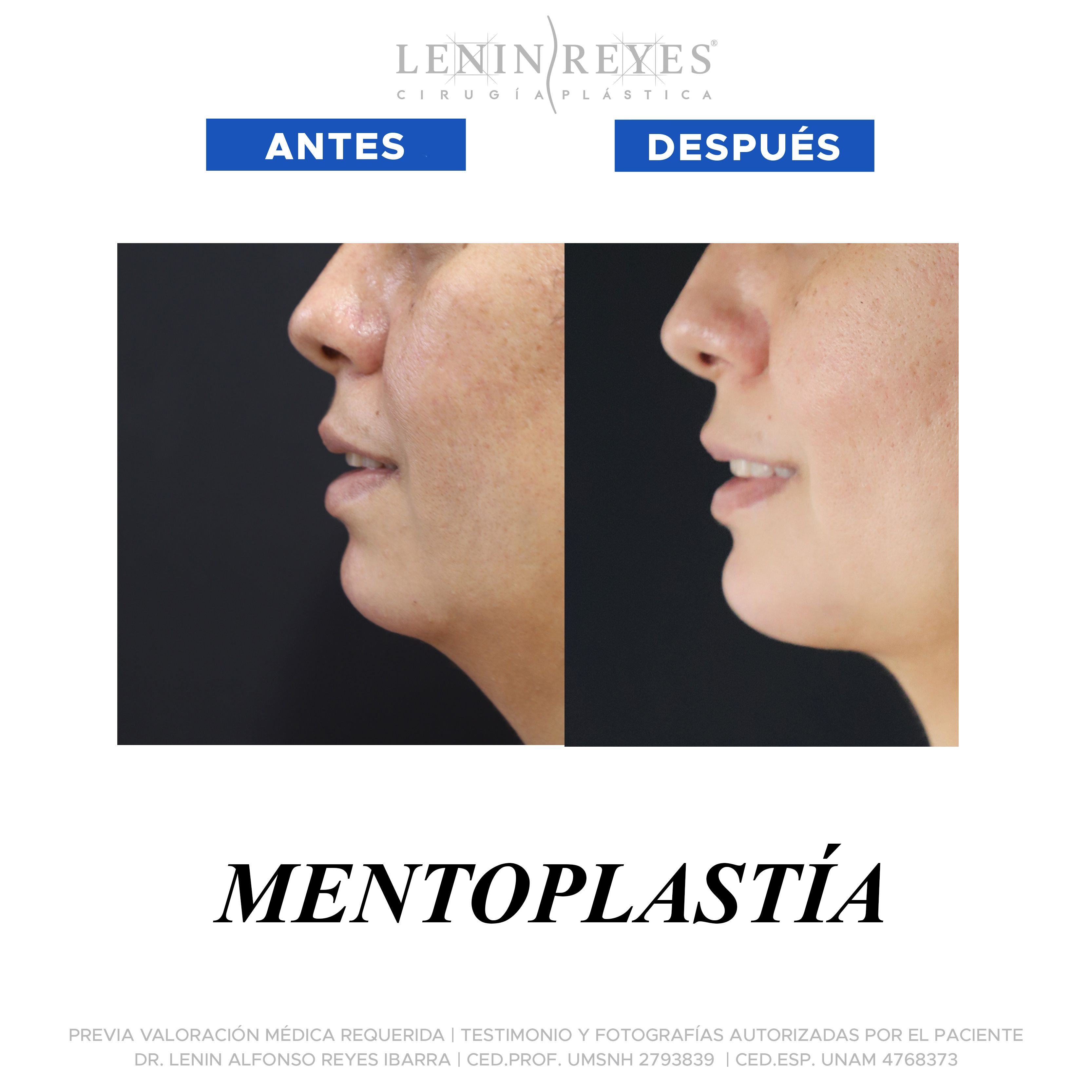 Mentoplastia Antes y después - Multiestetica.mx - Multiestetica.mx