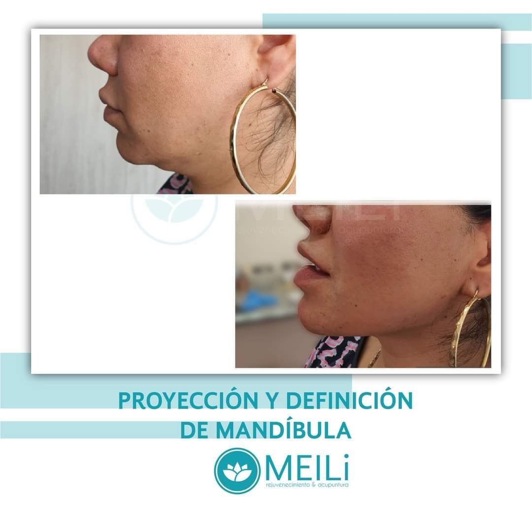 MEILi Rejuvenecimiento. - Multiestetica.mx