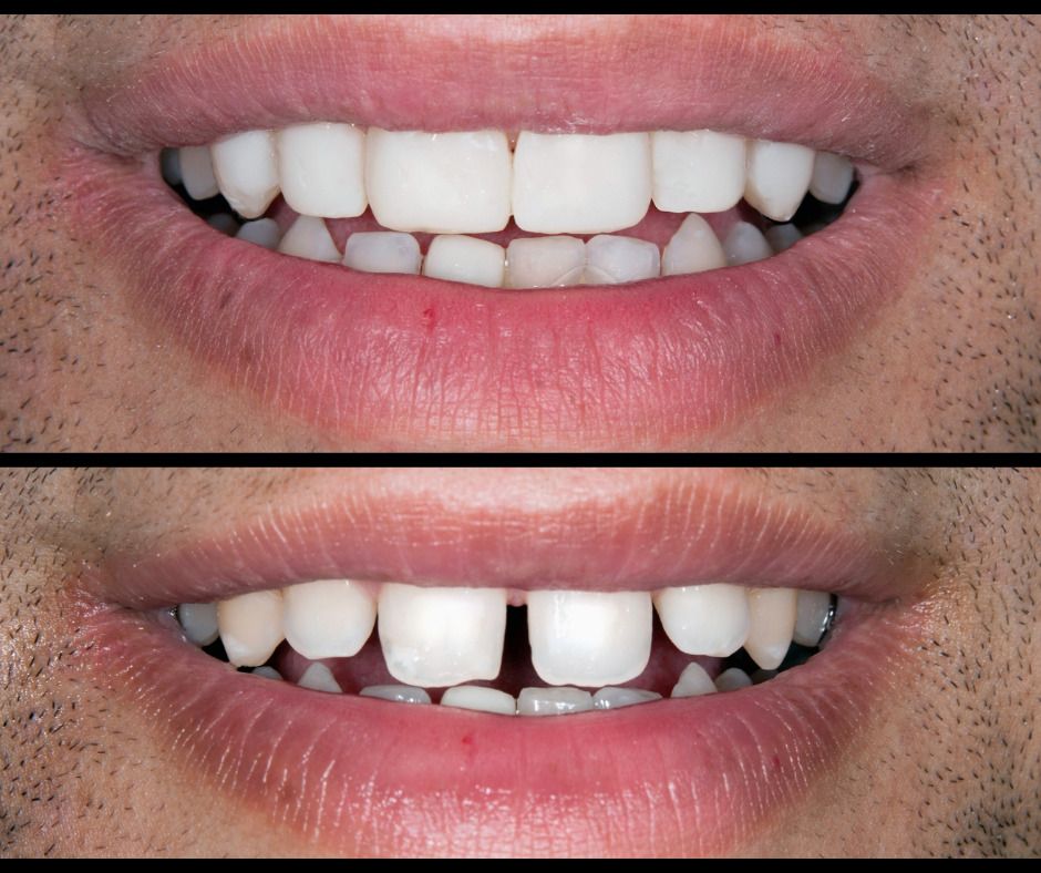 Implantes Dentales Antes y después - Multiestetica.mx