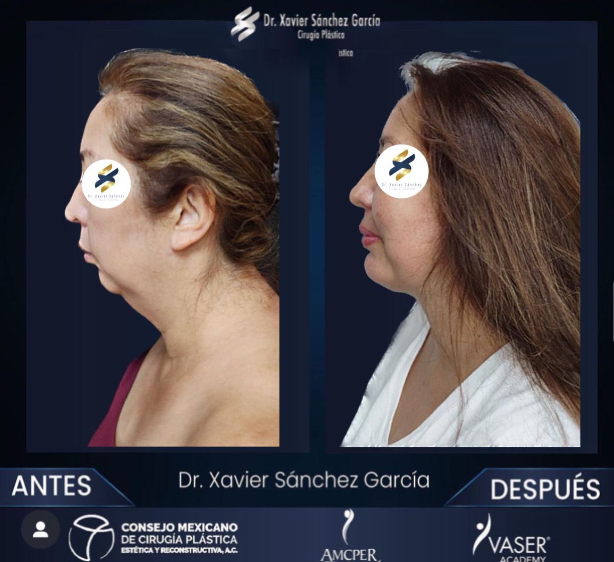 Cirugía de papada Antes y después - Multiestetica.mx - Multiestetica.mx