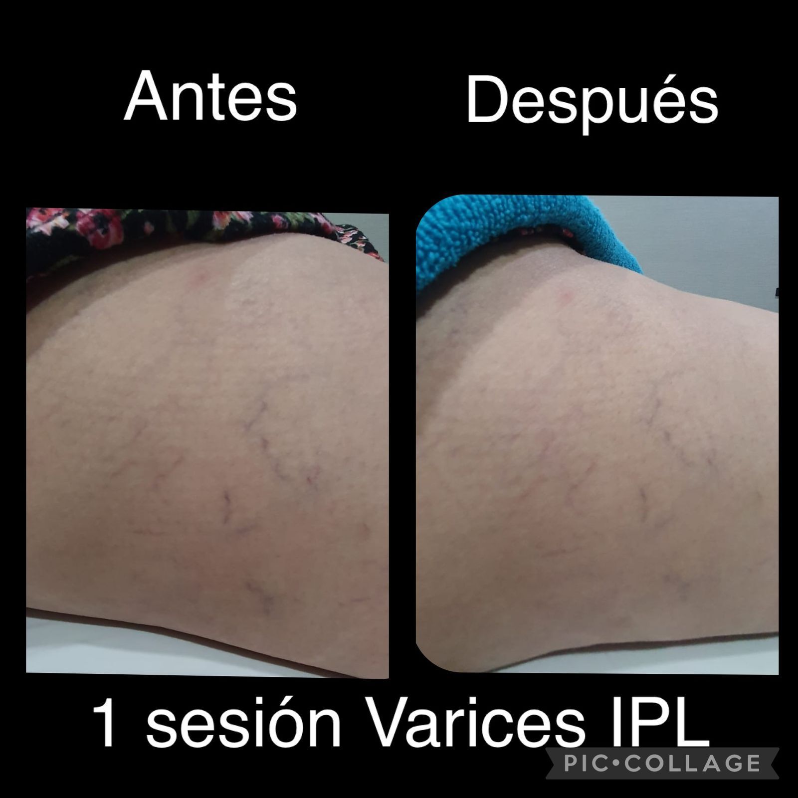 Cirugía varices Antes y después - Multiestetica.mx - Multiestetica.mx