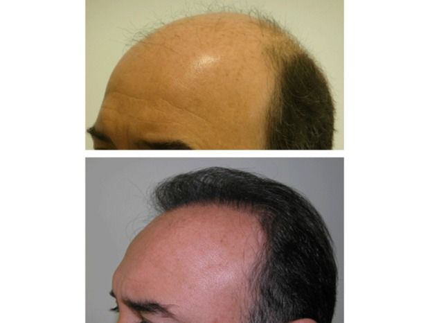 Kaloni Hair Restoration - Multiestetica.mx
