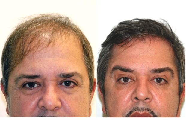 Kaloni Hair Restoration - Multiestetica.mx