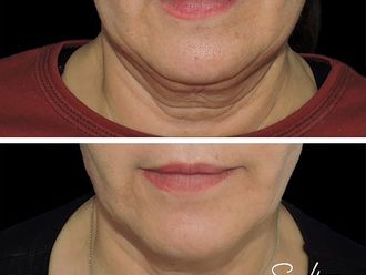 Clínicas de Cirugía de papada en Culiacán (Sinaloa) - Multiestetica.mx