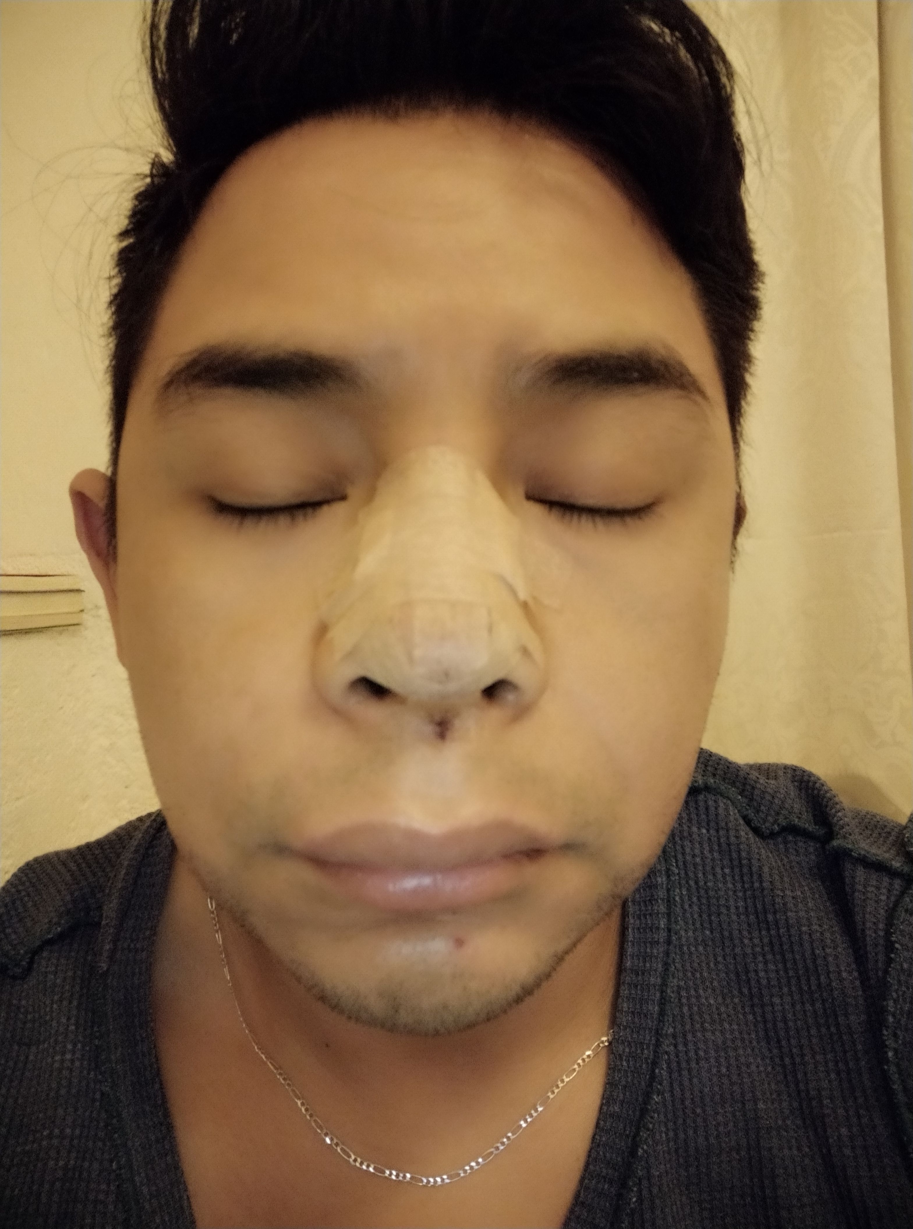 Inflamación del labio superior después de la rinomodelacion ...