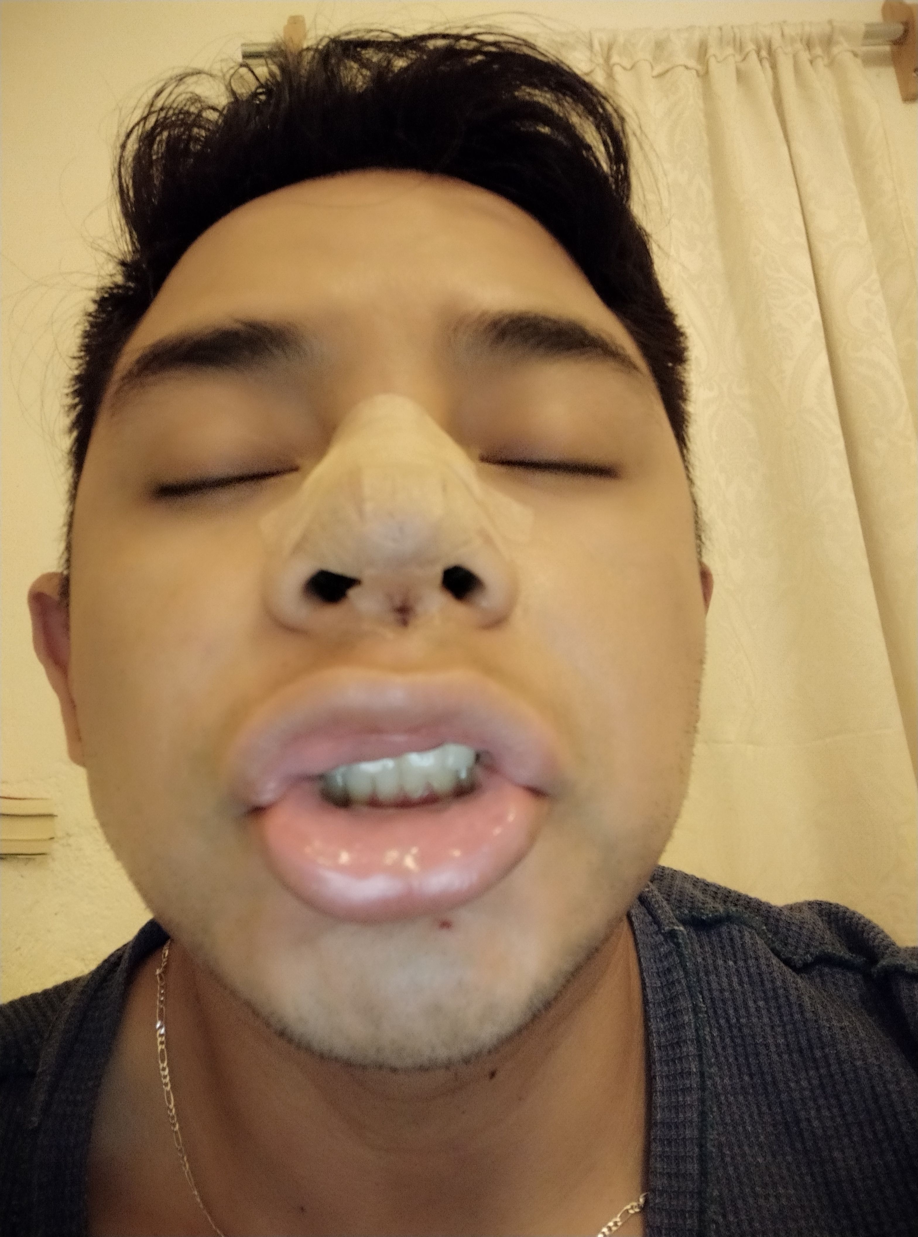 Inflamación del labio superior después de la rinomodelacion ...