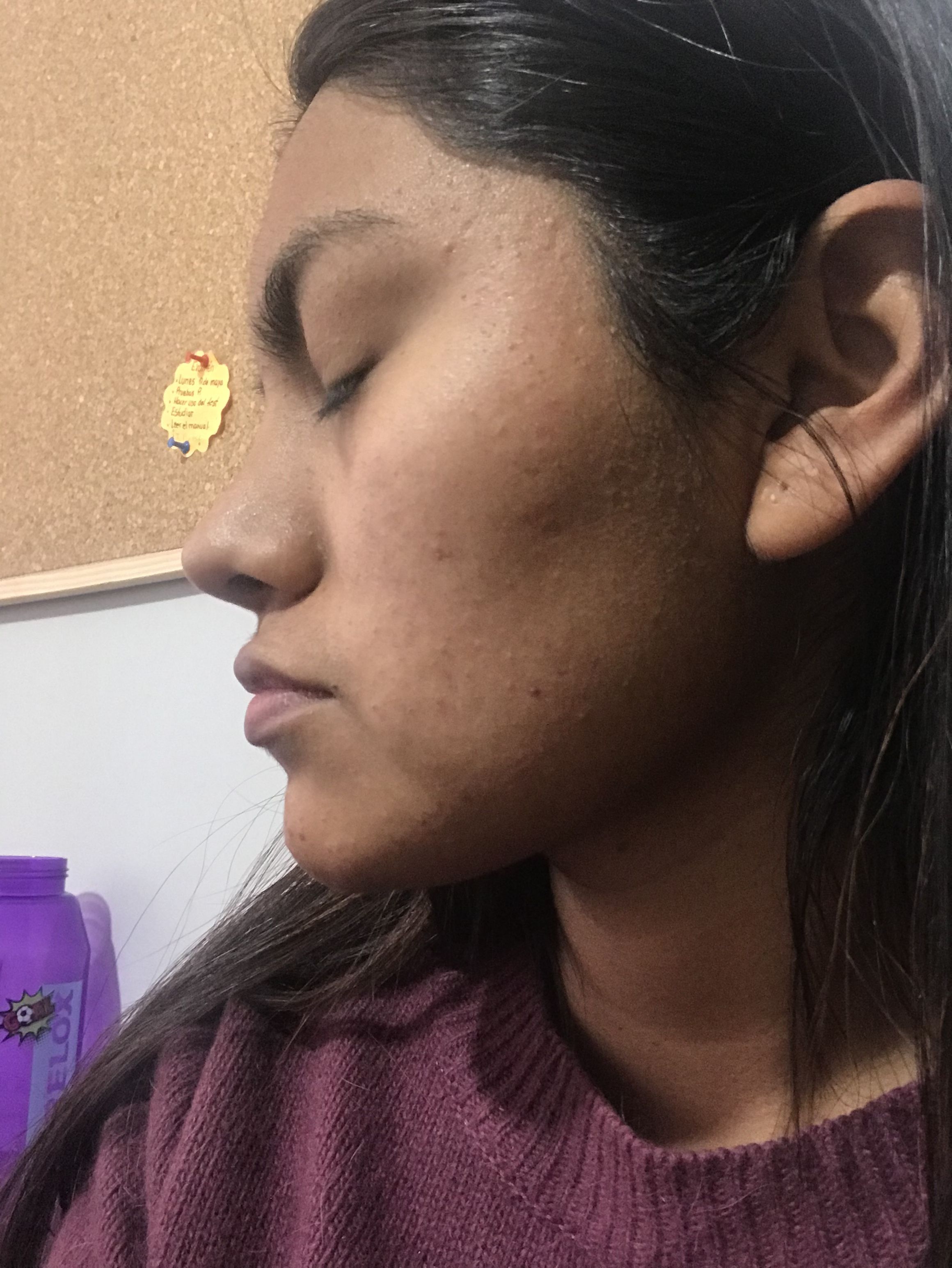 Rinoplastia, mi nariz muy respingada - Rinoplastia - Multiestetica.mx