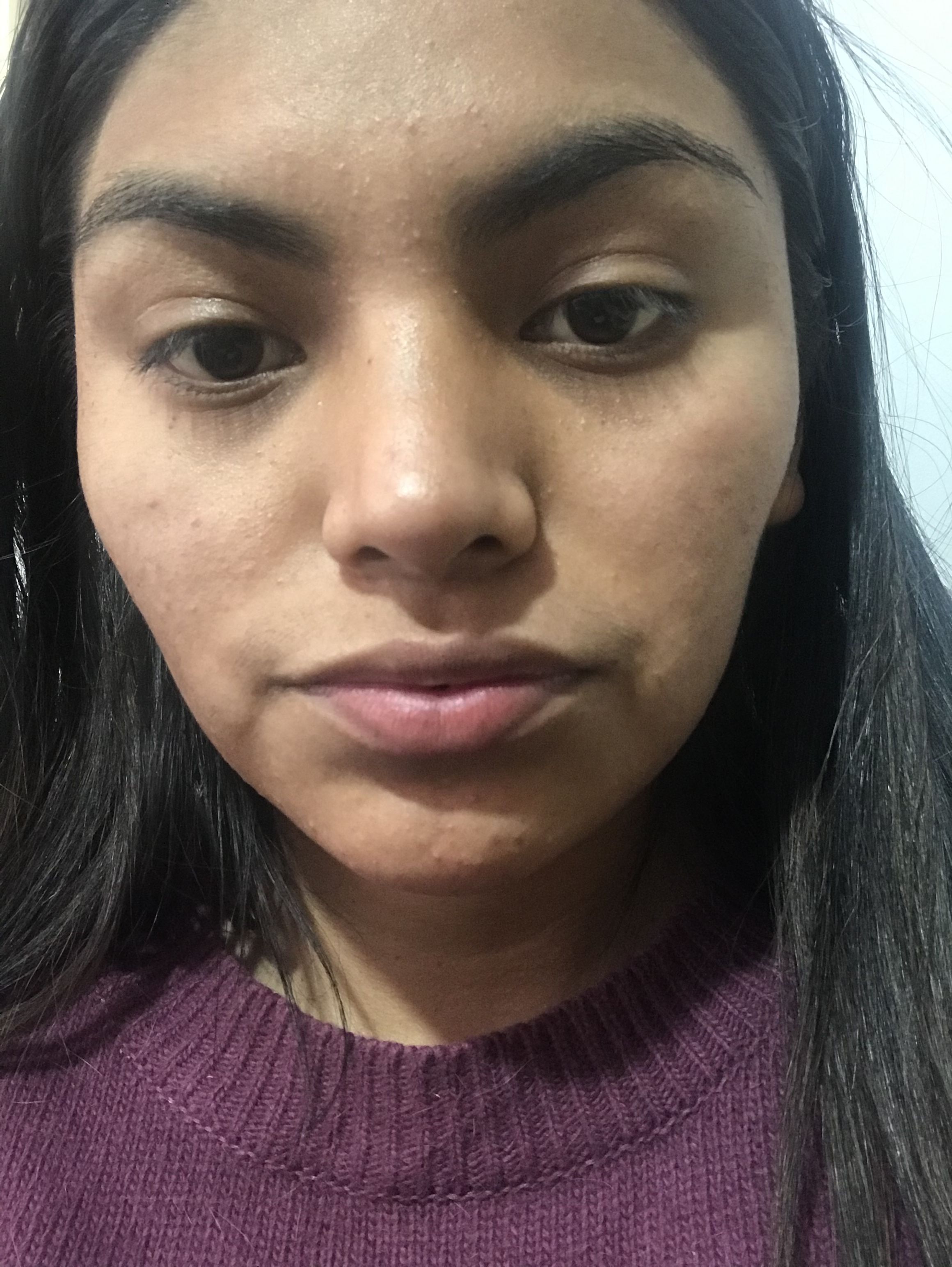 Rinoplastia, mi nariz muy respingada - Rinoplastia - Multiestetica.mx