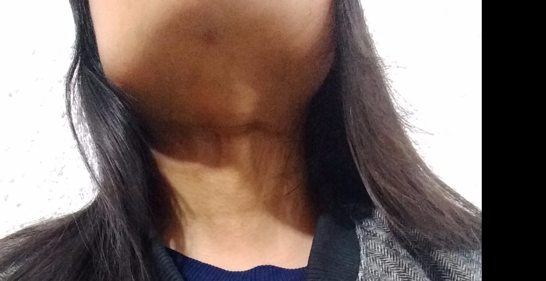 A mes y medio de mi liposucción de papada - Cirugía de papada ...