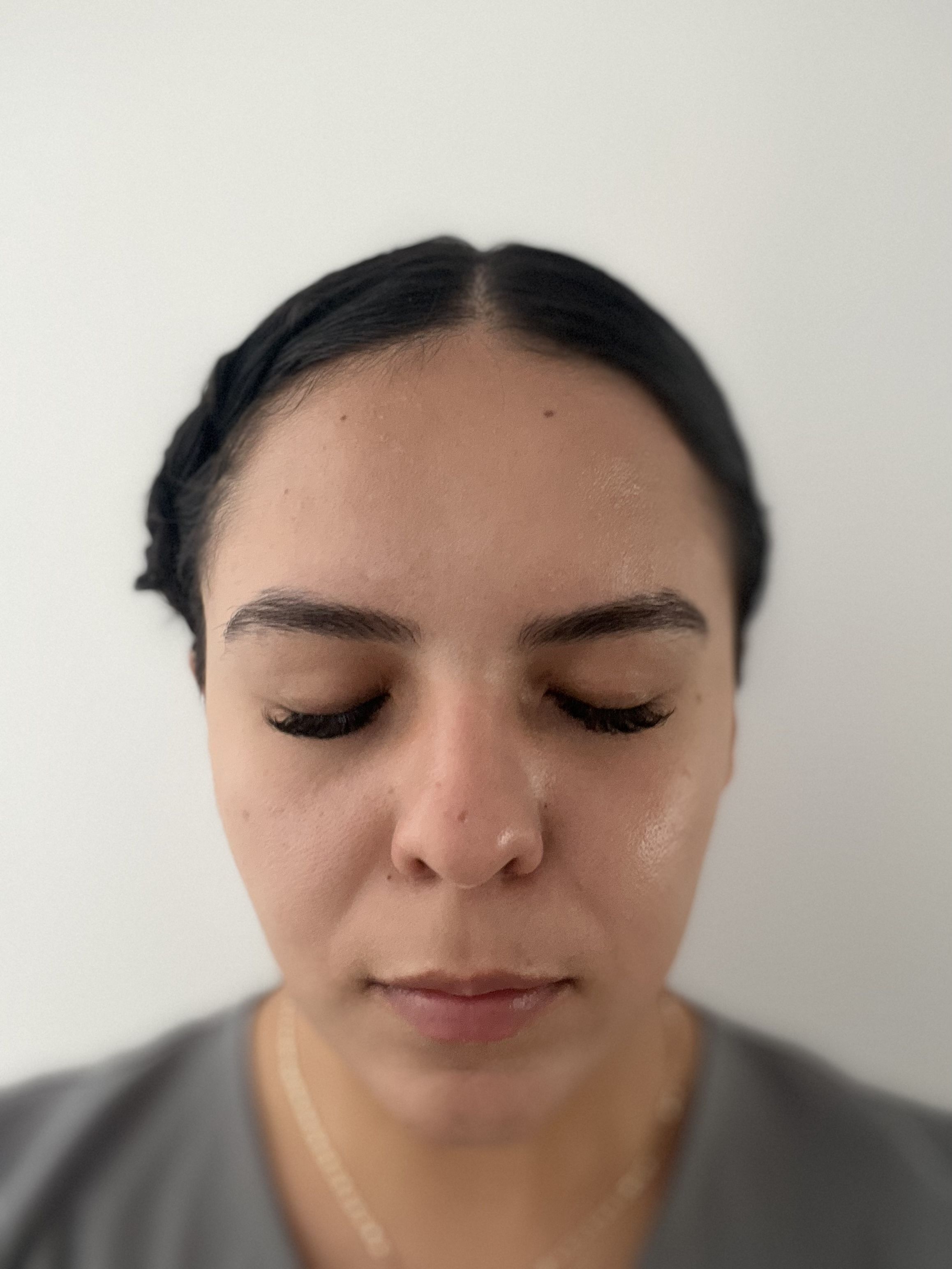 Me encanto mi procedimiento, cero dolor - Bolsas de Bichat ...