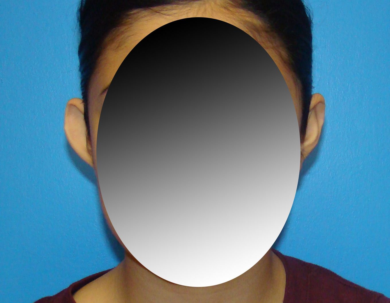 orejas mas bonitas y naturales - Otoplastia - Multiestetica.mx