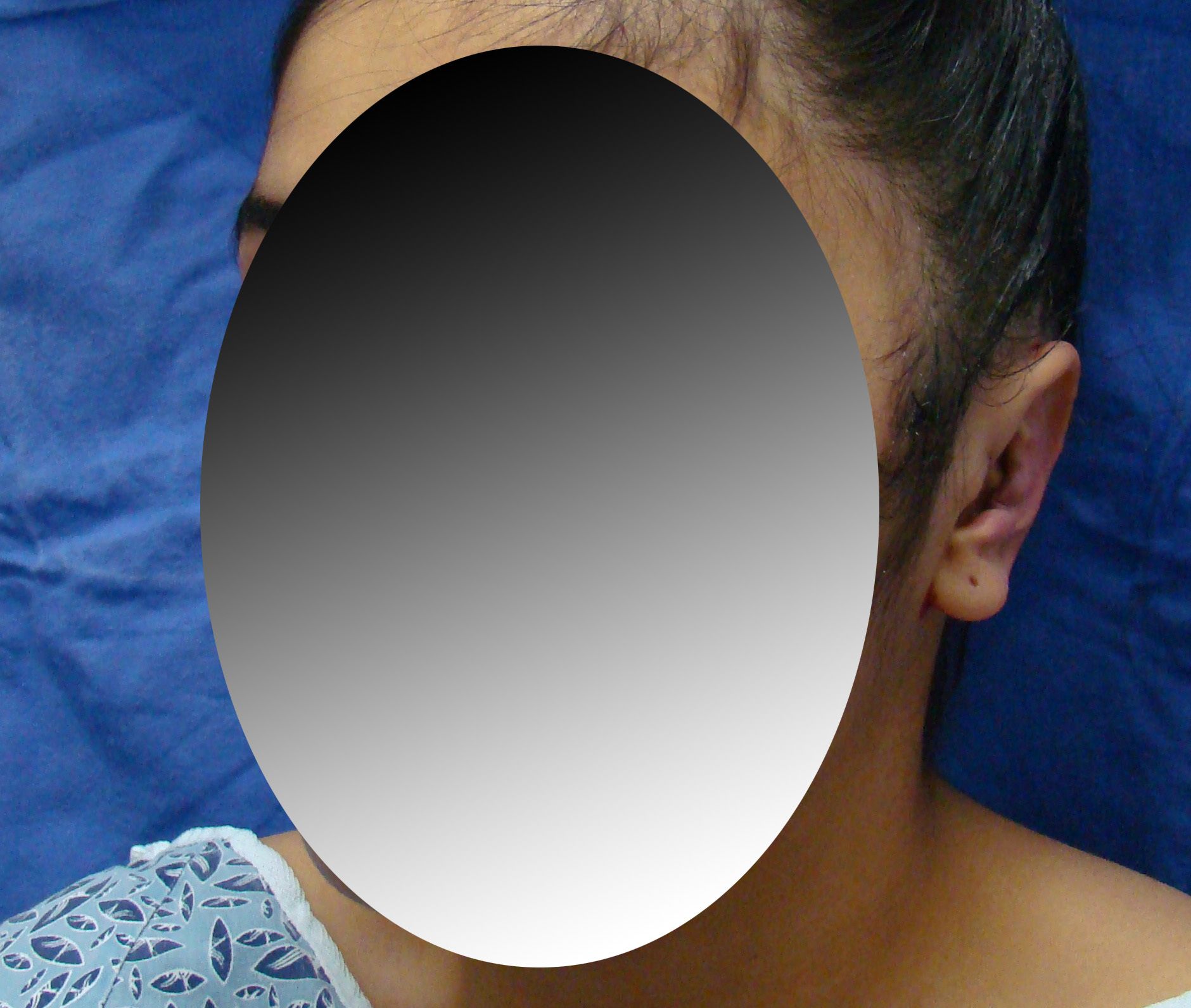 orejas mas bonitas y naturales - Otoplastia - Multiestetica.mx