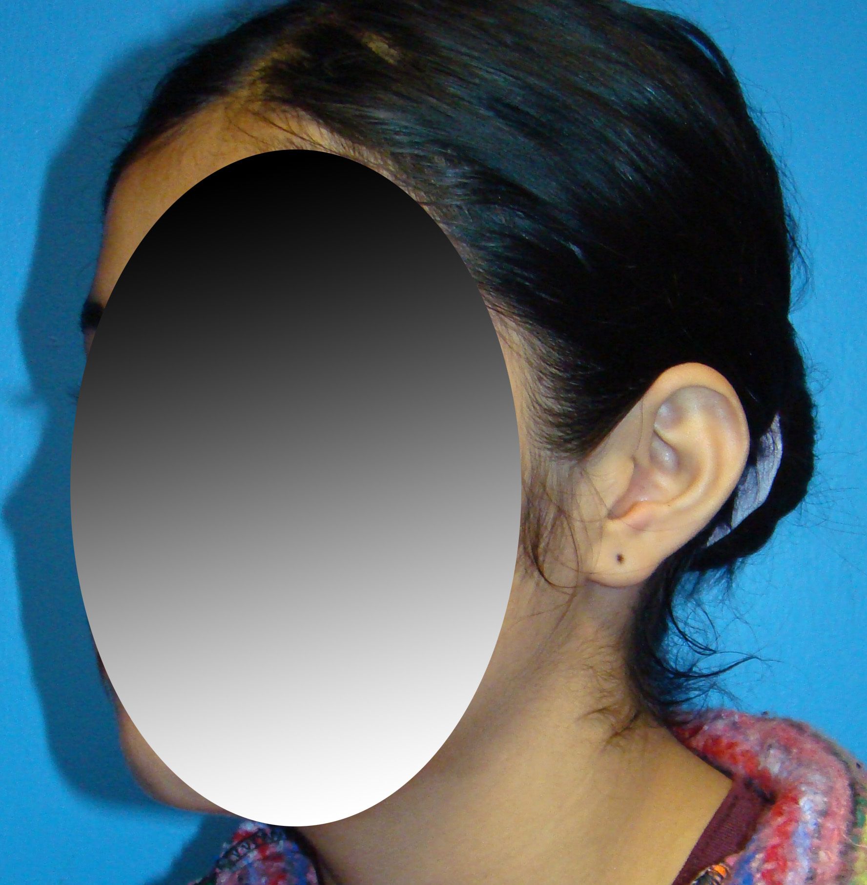 orejas mas bonitas y naturales - Otoplastia - Multiestetica.mx