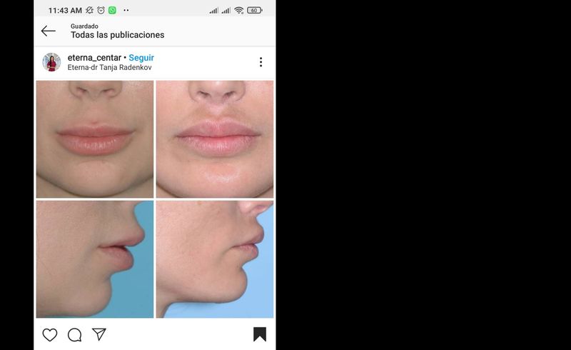Lip lift levantamiento de labios, MonchisMochilas, dic 2020