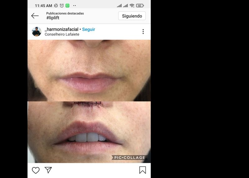 Lip lift levantamiento de labios, MonchisMochilas, dic 2020