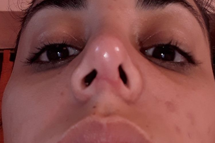 Punta de la nariz hinchada después de rinoplastia - Multiestetica.mx