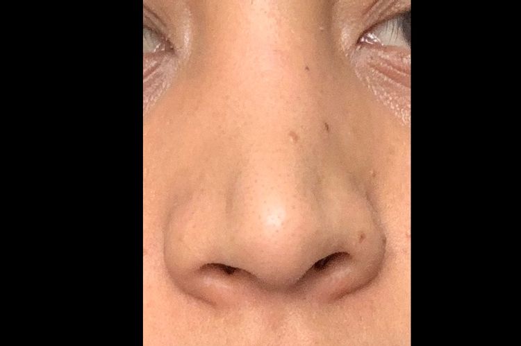 Necrosis después de rinoplastia - Multiestetica.mx