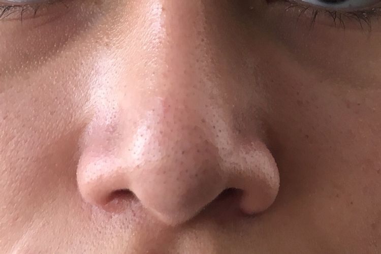 Fibrosis después de una rinoplastía - Multiestetica.mx