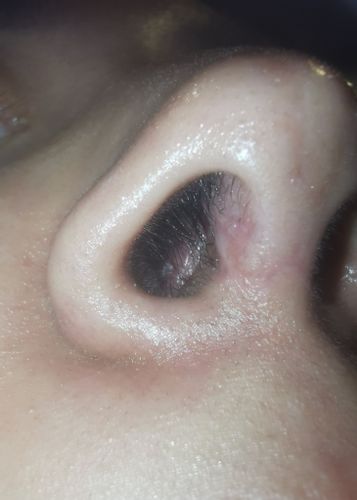 Fosas Nasales Desiguales 5 Meses Después De Rinoplastia Multiestetica Mx