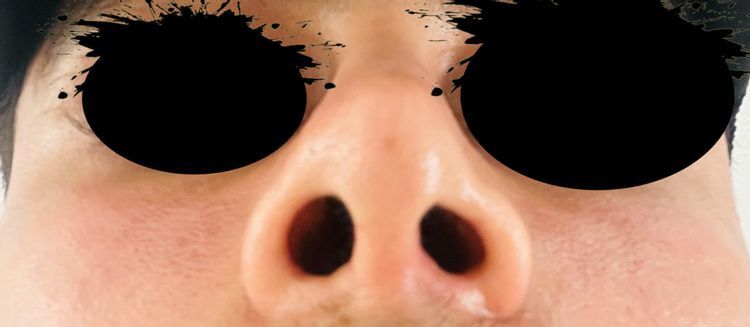 Punta nariz hinchada después de un año de rinoplastia - Multiestetica.mx