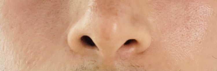 Punta nariz hinchada después de un año de rinoplastia - Multiestetica.mx