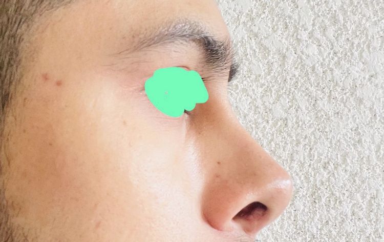Punta nariz hinchada después de un año de rinoplastia - Multiestetica.mx
