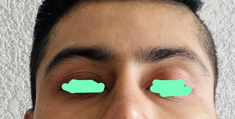 Tratamiento adecuado para las ojeras - Multiestetica.mx