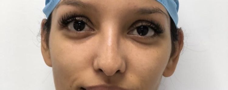 Tratamiento para colapso alar tras rinoplastia - Multiestetica.mx