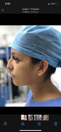 Tratamiento para colapso alar tras rinoplastia - Multiestetica.mx