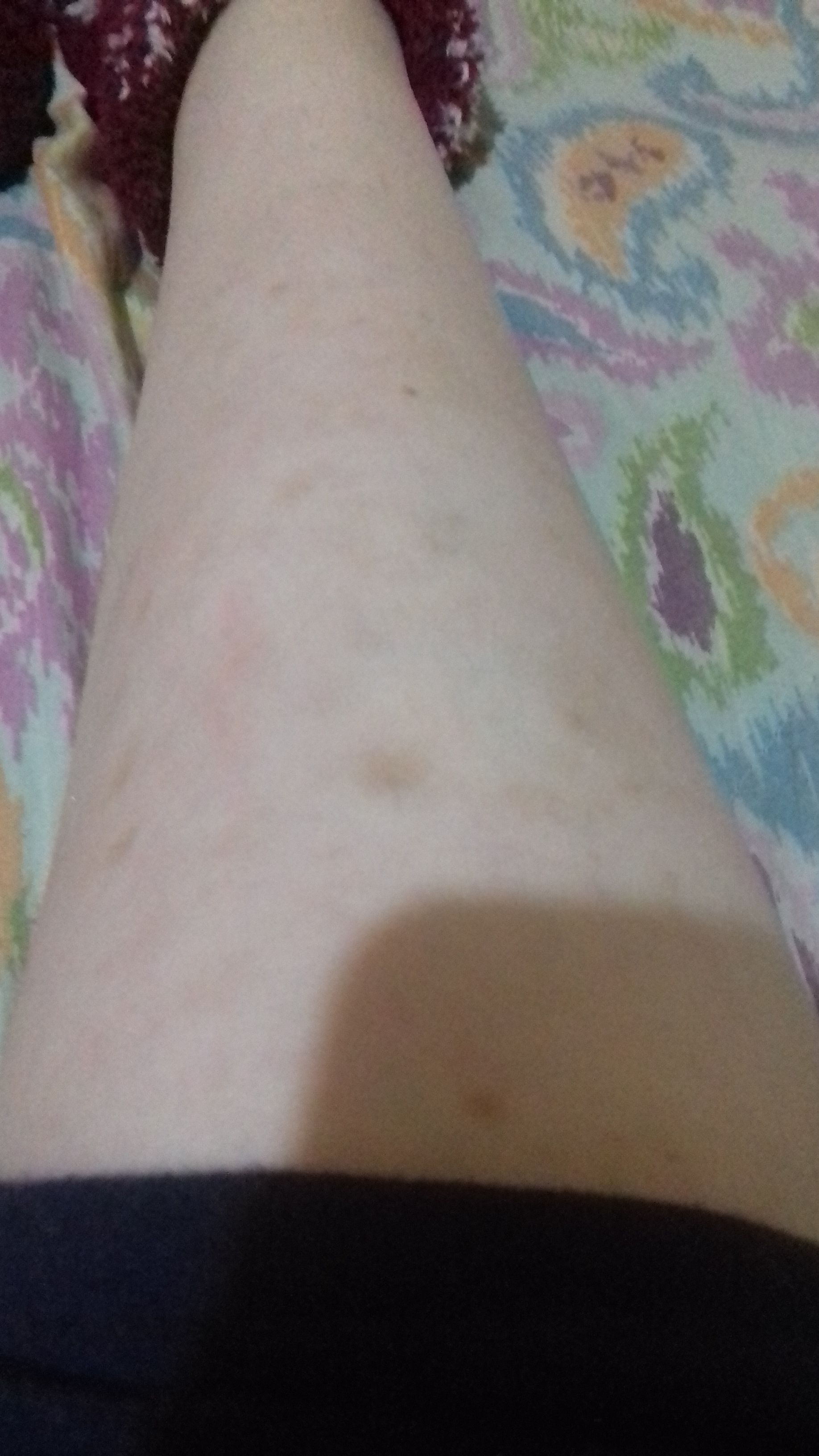 Manchas en las piernas - Multiestetica.mx